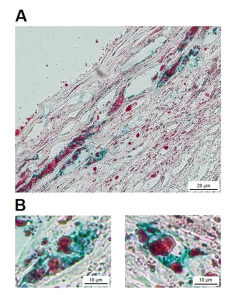 Atheromatous Plaque Cryosections With Combined Oil Red O Oro And