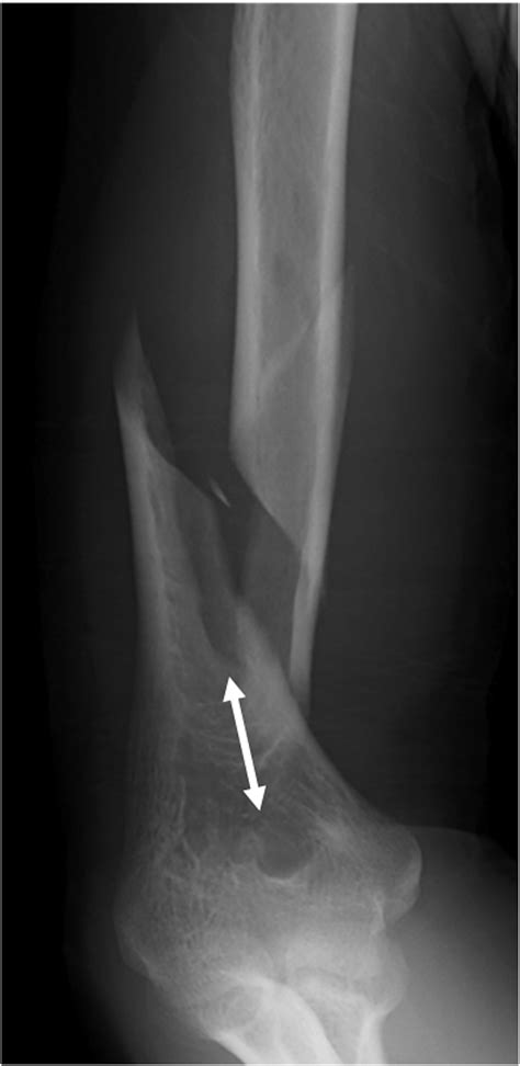 Comparative Outcomes Of Anterior And Posterior Plating For Distal Third