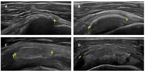 Can Secondary Adhesive Capsulitis Complicate Calcific Tendinitis Of The Rotator Cuff An