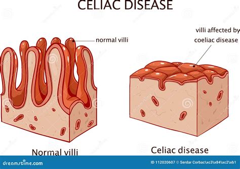 Coeliac Disease Or Celiac Disease Small Bowel Showing Coeliac D Stock