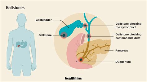 Gallstones In Pregnancy