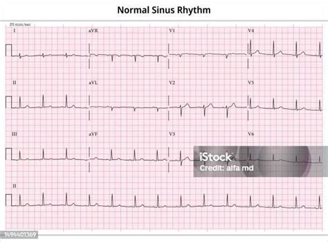 Ecg Normal Sinus Rhythm 12 Lead Ecg Common Case 3 Sec Lead Stock