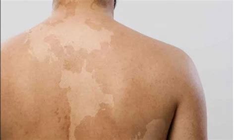 ചണങങ കതയമയ ചകതസ തട Health news skin rash can be treated properly Madhyamam