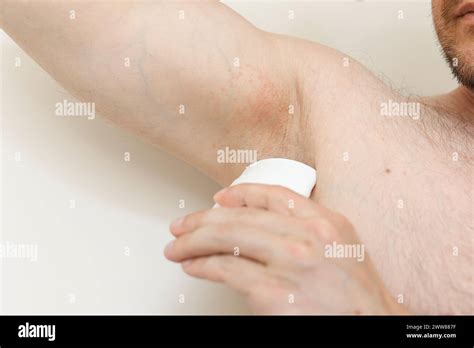 Young Man With Irritation Inflammation On Sensitive Underarm Skin