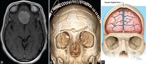 An Illustrative Review Of Common Modern Craniotomies Pmc