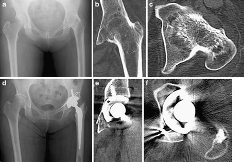 Radiographs And Computed Tomograms Of Case 2 A A Preoperative