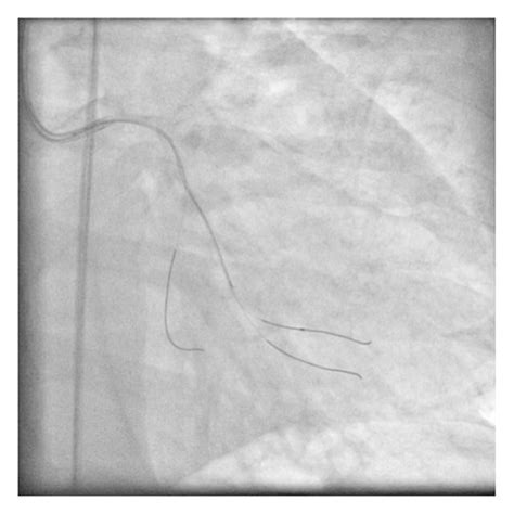 A Lao Cranial View Showing The Wire Over The Aorta To Mark The Rca