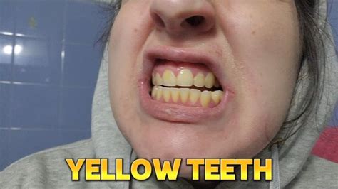 Brushing My Filthy Yellow Croocked Teeth Until They Shine Close Up