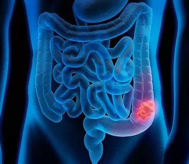 Cirugía en Cáncer Colon y Recto - Dr. Marco Juárez