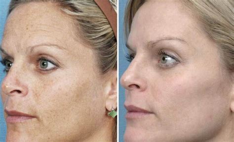 What Are Best Laser Types For Scar Removal A Guide To Co2 Ipl