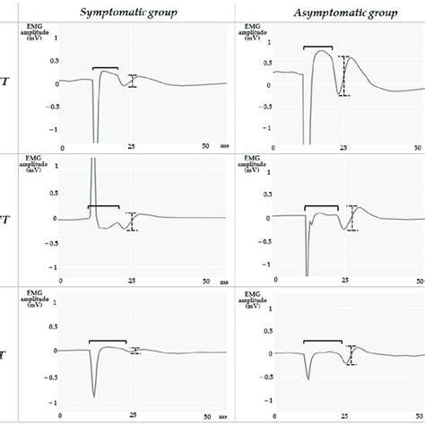 H Reflex Representation Average Of Ten Reflex Responses Evoked At The