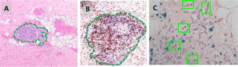 A Intratumoral Tertiary Lymphoid Structure Tls Green Outline Found