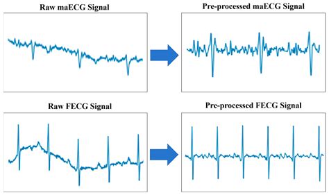 Fetal Ecg Signal Extraction From Maternal Abdominal Ecg Signals Using Attention R2w Net
