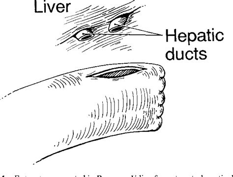Figure 1 From A Different Method Of Hepaticojejunostomy For Proximal