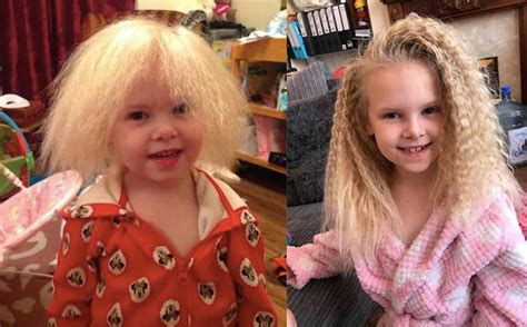 Uncontrollable Hair Syndrome Girl 9 Finally Able To Have Her Hair