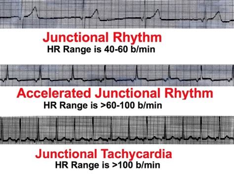Idioventricular Vs Junctional Isorhythmic Av Dissociation Id Vs