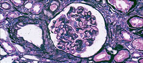 C3 Glomerulopathie Bij Een Mgrs Op Basis Van Een Monoklonaal Iga Kappa