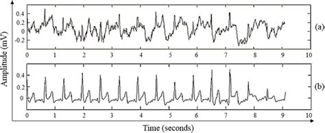 A Ecg With Motion Artefacts B Ecg At Rest Download Scientific Diagram