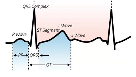 arrhythmia detection with the ek pro algorithm clinical view
