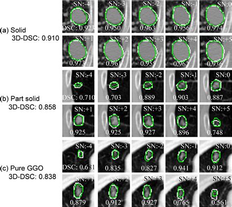 Figure 1 From Automated Approach For Segmenting Gross Tumor Volumes For
