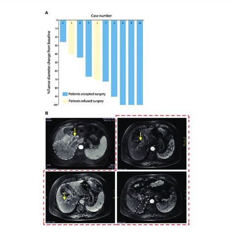 Tumor Shrinkage After The Conversion Therapy A Waterfall Plot Of Download Scientific