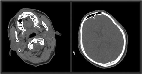 Numerous Small Subcutaneous Calcifications Are Seen From The Jaw To The Download Scientific