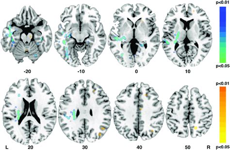 Tract Based Spatial Statistics Tbss Analysis Of Acute Imaging