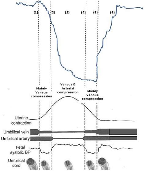 Truthful Pathophysiological Cord Compression Deceleration Schematic Download Scientific