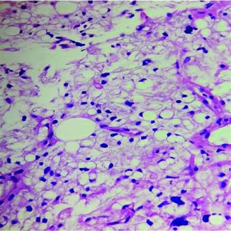 Cmls Cardiac Myxoid Liposarcoma Histology Download Scientific Diagram