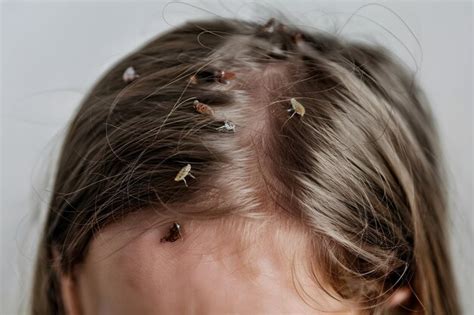 Head Lice Infestation Treatment Market Size And Projection