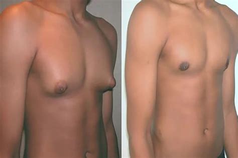 Gynecomastia Surgery In Hyderabad Gynecomastia Treatment