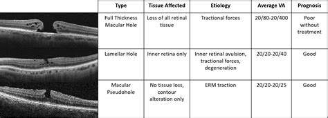 When Your Patient Develops A Full Thickness Macular Hole