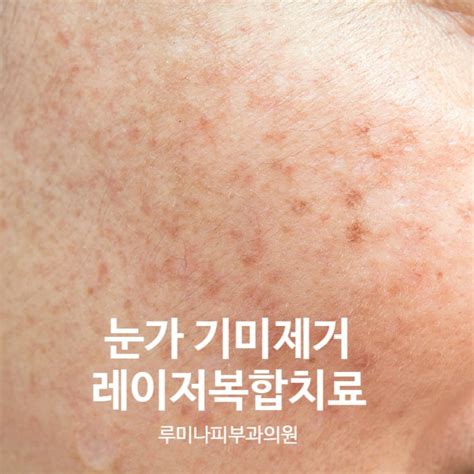 신봉동피부과눈가 기미레이저 피코토닝만 해선 안됩니다 네이버 블로그
