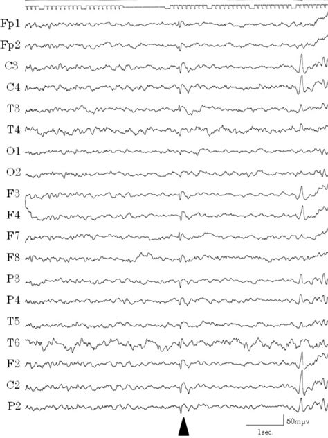 Spike And Wave Complexes Spike And Wave Complexes Were Recorded In T3