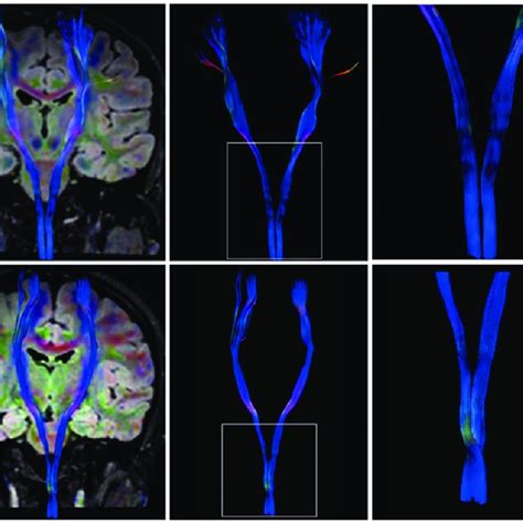 Synkinetic Contralateral Movements Mirror Movements With Distal Motor