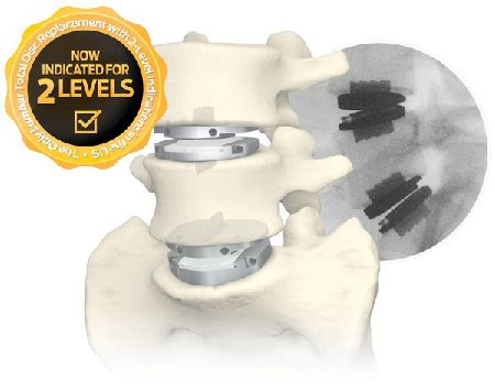 New CPT Code Now Effective For Second Level Of Lumbar Total Disc Replacement Procedures