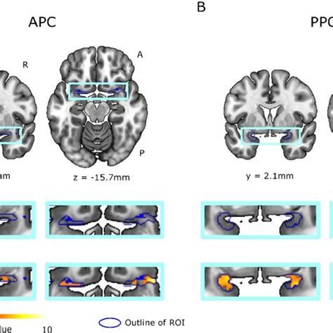 Whole Brain Mr Imaging Results A The Location Of The Anterior Download Scientific Diagram