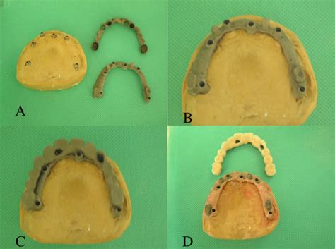 Hybrid Prosthesis Laboratory Stages A Master Casts And Substructure Download Scientific
