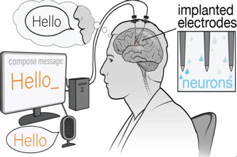 Studypages BrainGate Feasibility Study Of An Intracortical Neural Interface System For