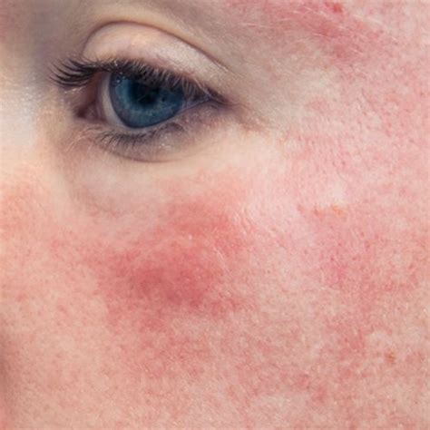 How To Get Rid Of Red Spots On Your Face Causes Treatments And