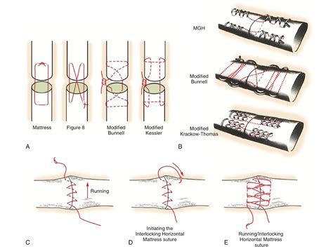 Extensor Tendon Anatomy Injury And Its Mangement Pptx Pptx