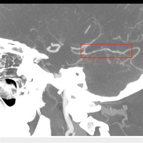 Sagittal View Of The String Of Beads Appearance Indicative Of Download Scientific Diagram