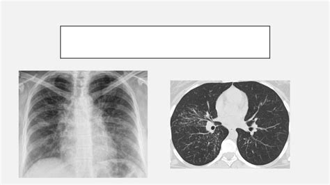 Презентация на тему САРКОИДОЗ ЛЕГКИХ