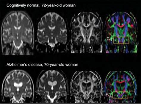 Dti And Structural Mri Classification In Alzheimers Disease My Xxx