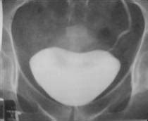 LearningRadiology Com Basics Of Intravenous Urography IVP IVU