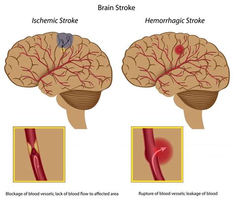 What Is An Embolic Stroke With Pictures