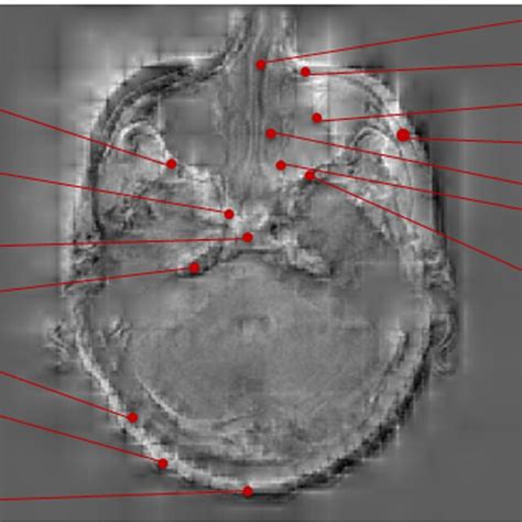 Foreground Segmentation Of Occipital Lobe And Zygomatic Arch Using Dywt Download Scientific