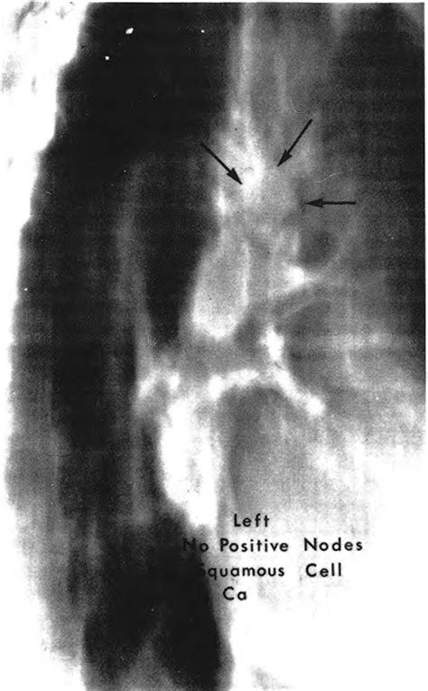 55° Oblique Hilar Tomography Mayo Clinic Proceedings