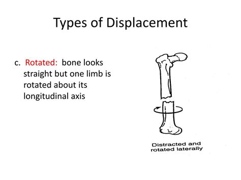 Ppt Bone Fracture Patterns Bone Healing Fracture Management Powerpoint Presentation Id5388100 Ppt Bone Fracture Patterns Bone Healing Fracture Management Powerpoint Presentation Id5388100