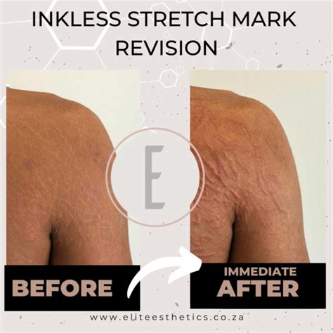 Inkless Stretch Mark Scar Revision Elite Esthetics Beauty Training Academy